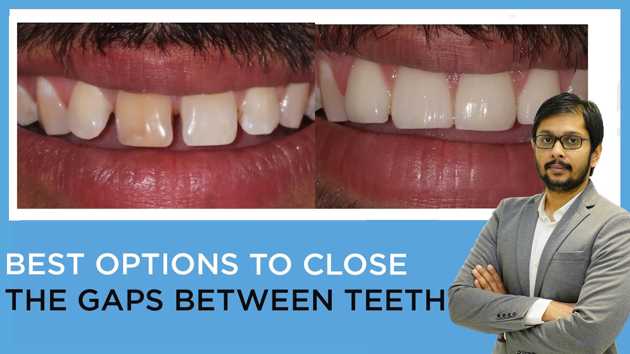 Best Options To Close The Gaps Between Teeth Dr Ankit Youtube
