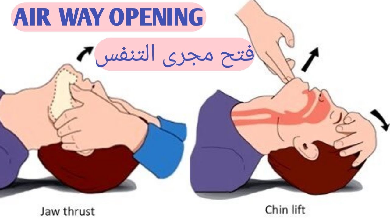 Chin Lift E Jaw Thrust At Gayla Wilson Blog