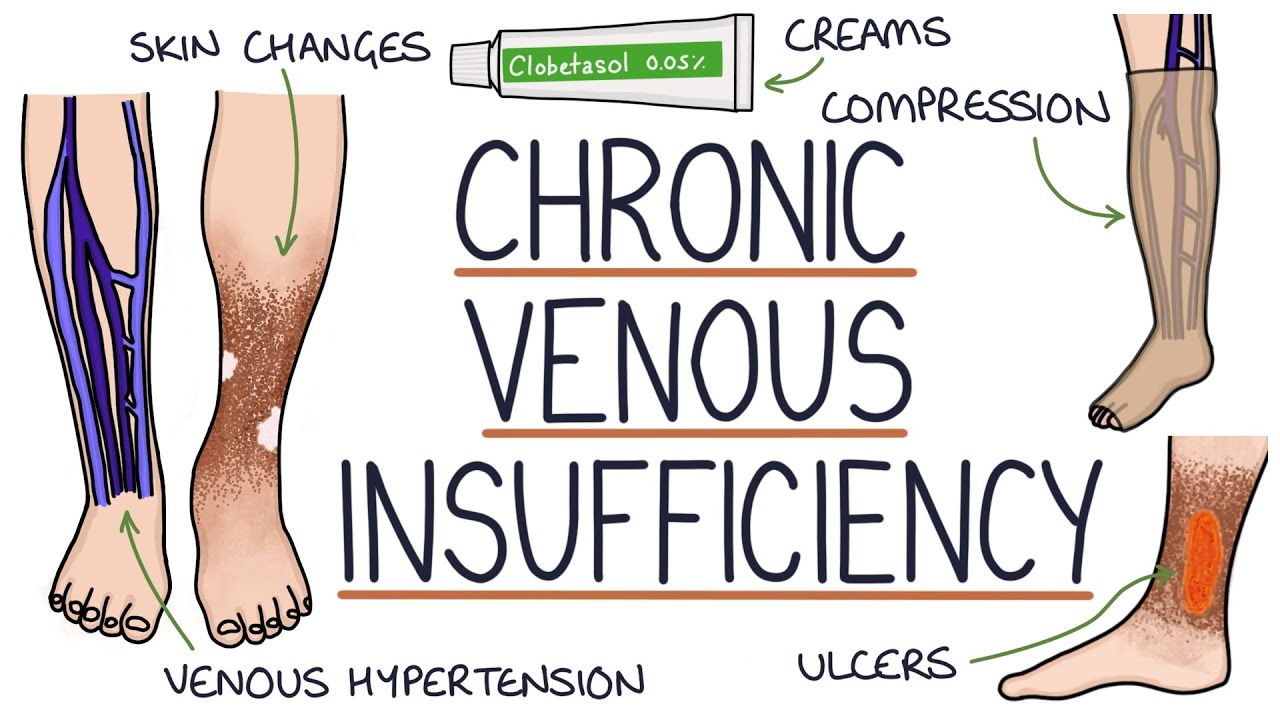 Chronic Venous Insufficiency Causes Symptoms And 41 Off