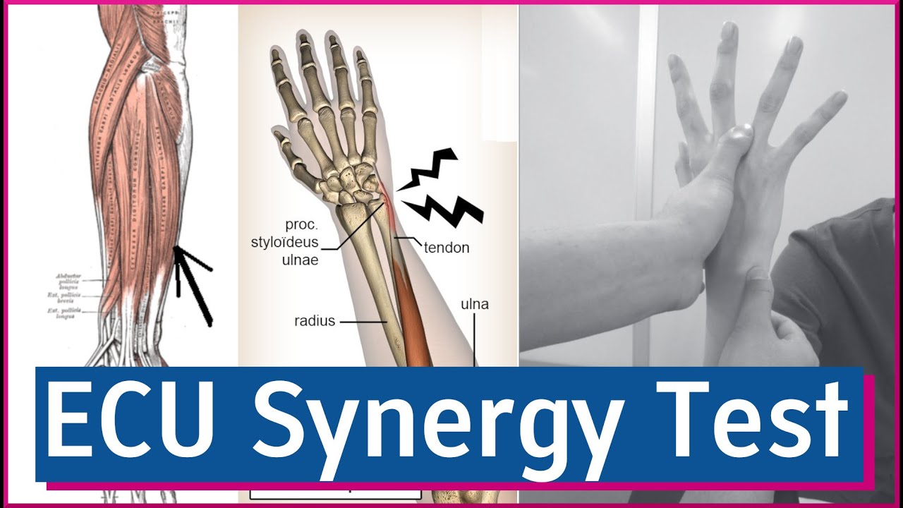 Ecu Synergy Test Ecu Tendinopathy Youtube