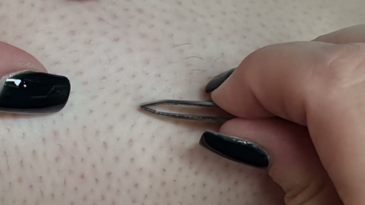 Satisfying Ingrown Hair Plucking And Removal Asmr Youtube