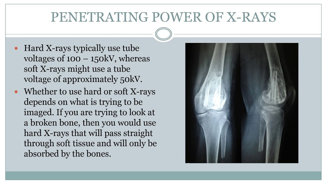 X Rays Uses X Rays Physiopedia