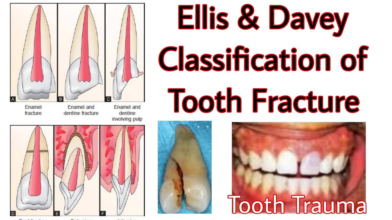 Ellis Davey Classification Of Tooth Fracture Tooth Trauma Tooth