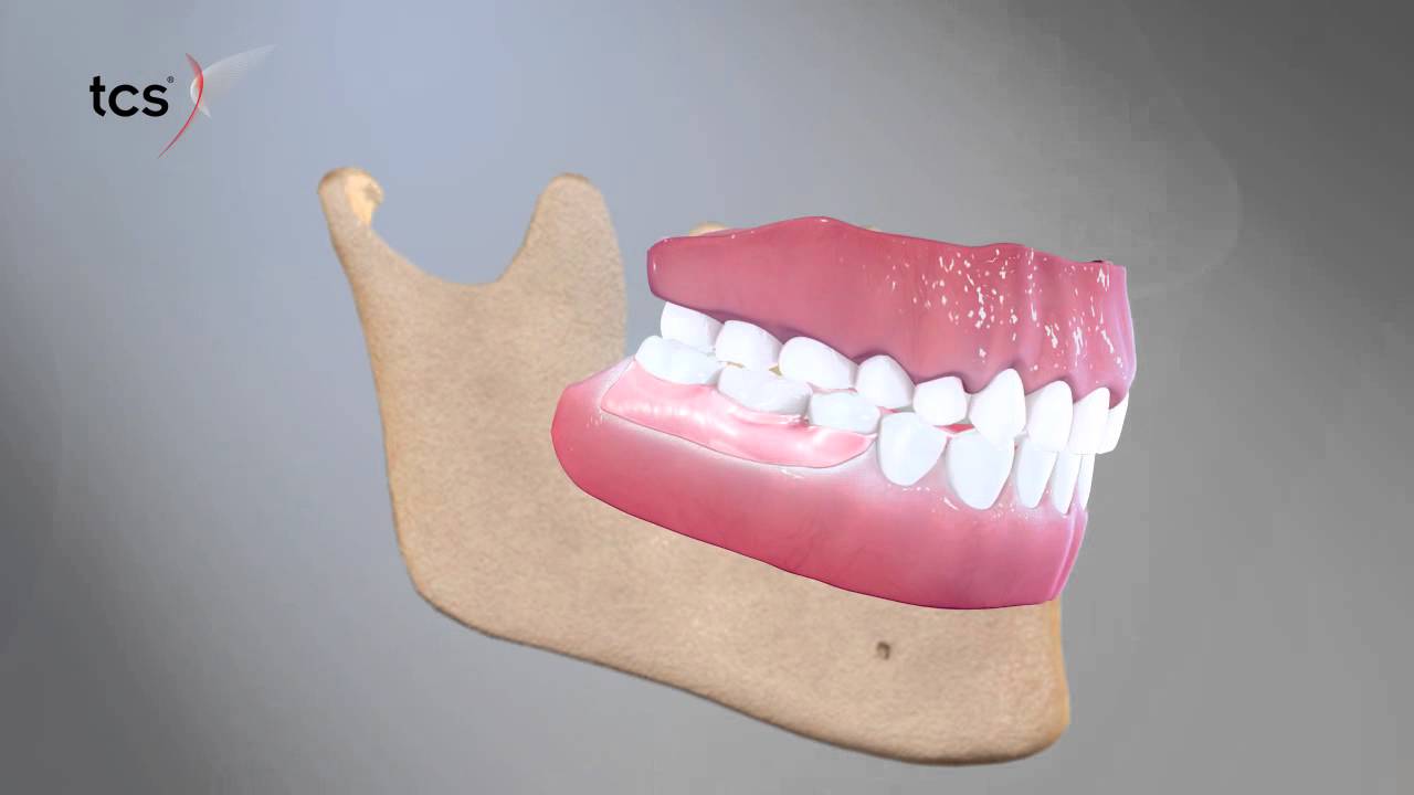 Tcs Flexible Partial Dentures Animation Video Youtube