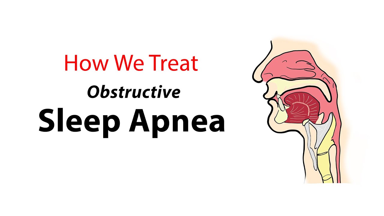 How We Treat Obstructive Sleep Apnea Youtube