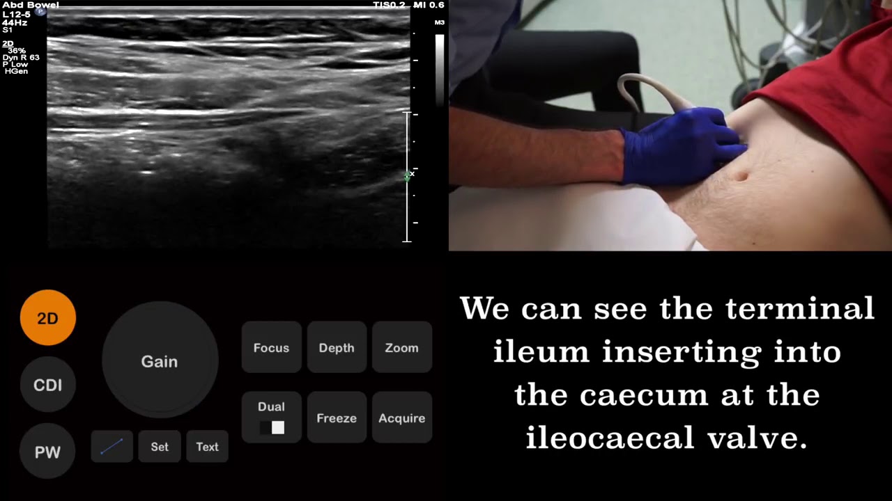 Ultrasound Tutorial Appendix Appendicitis Radiology Nation Youtube
