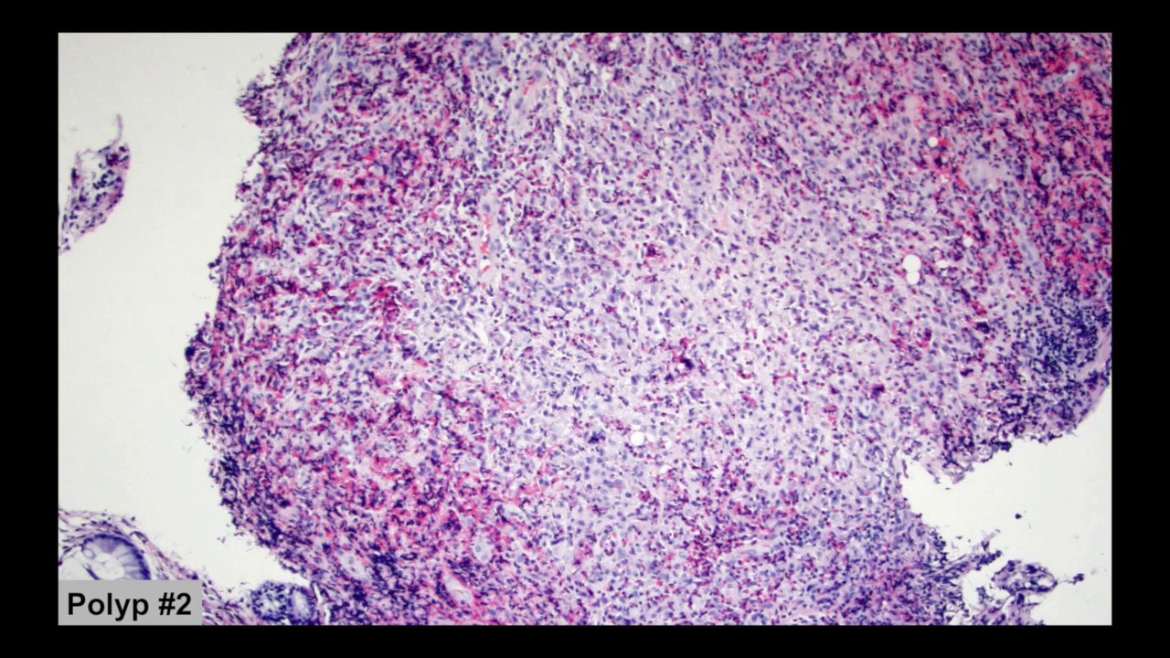 Cases With Dr Keeney Case 3 Youtube