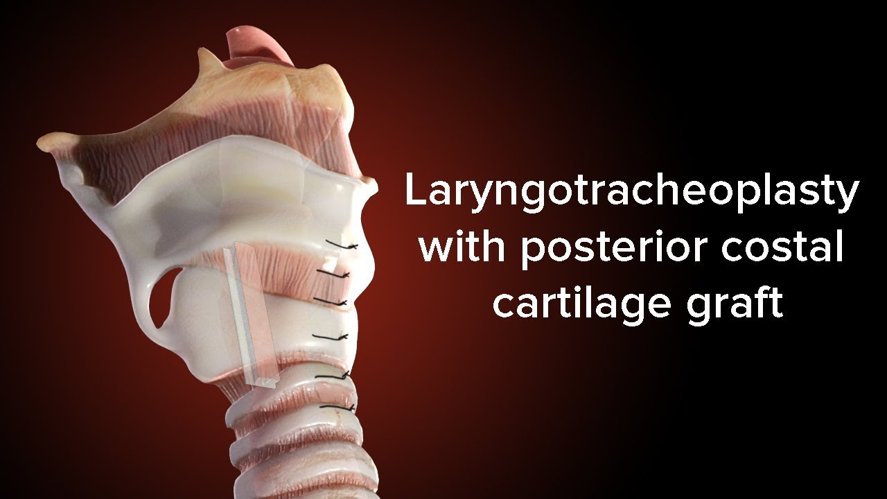 Medical Animation Posterior Cricoid Split Cincinnati Children S
