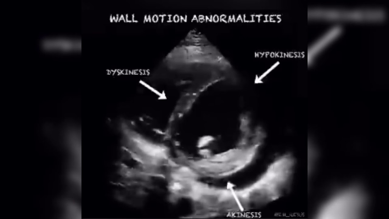 Wall Motion Abnormalities The Echo Channel Youtube