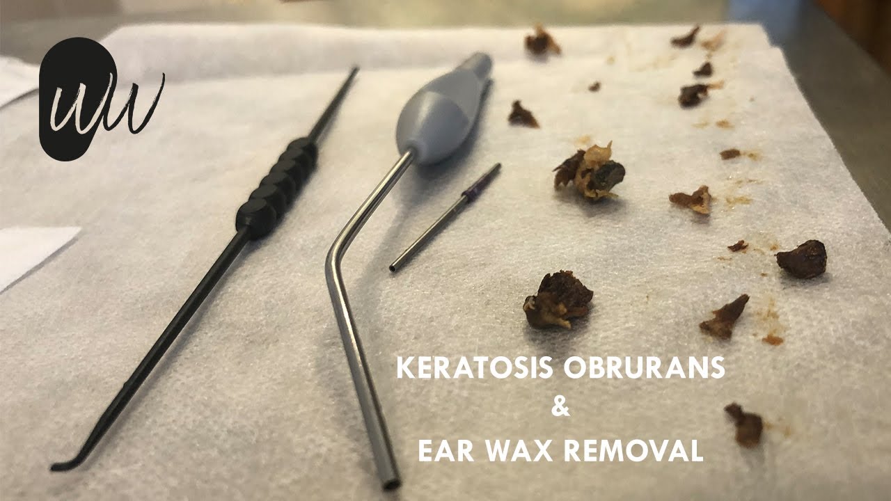 502 Keratosis Obturans Ear Wax Removal Youtube