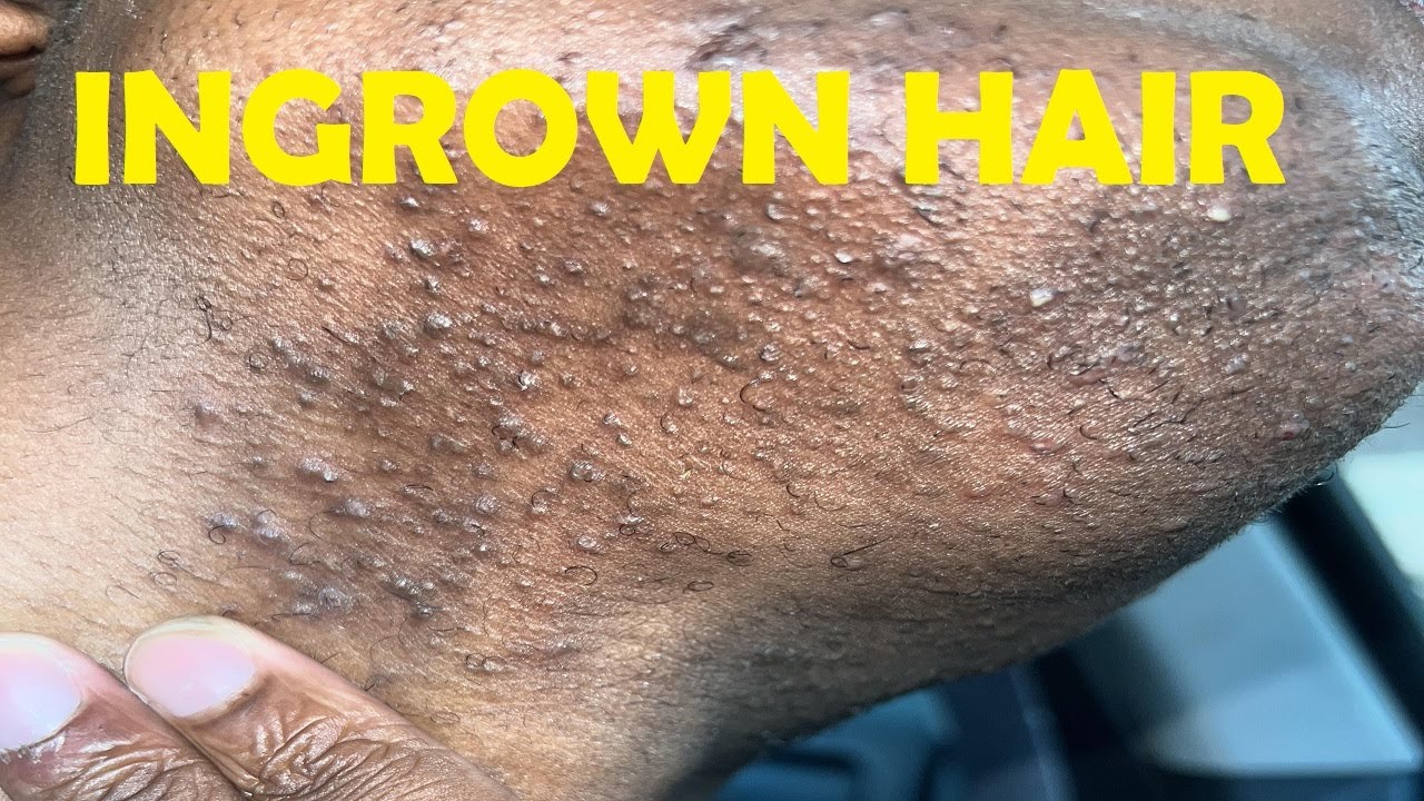 Easy Way To Get Rid Of An Ingrown Hair On Your Face Youtube