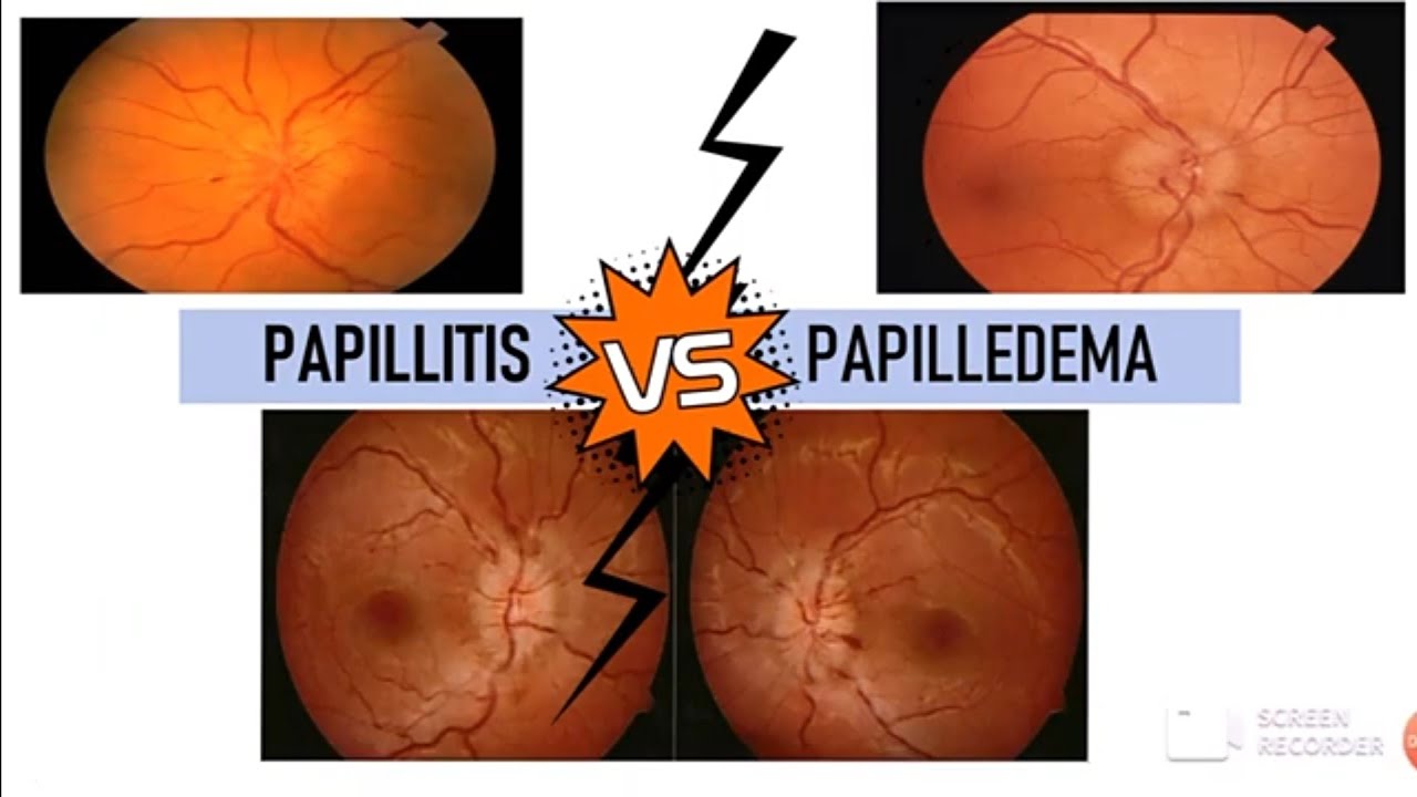 Optic Neuritis Vs Papilledema