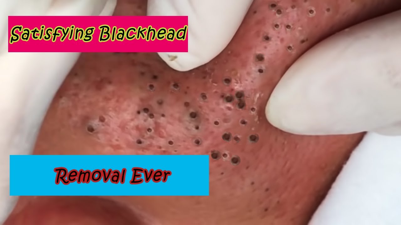 Most Satisfying Blackhead Popping Ever Youtube