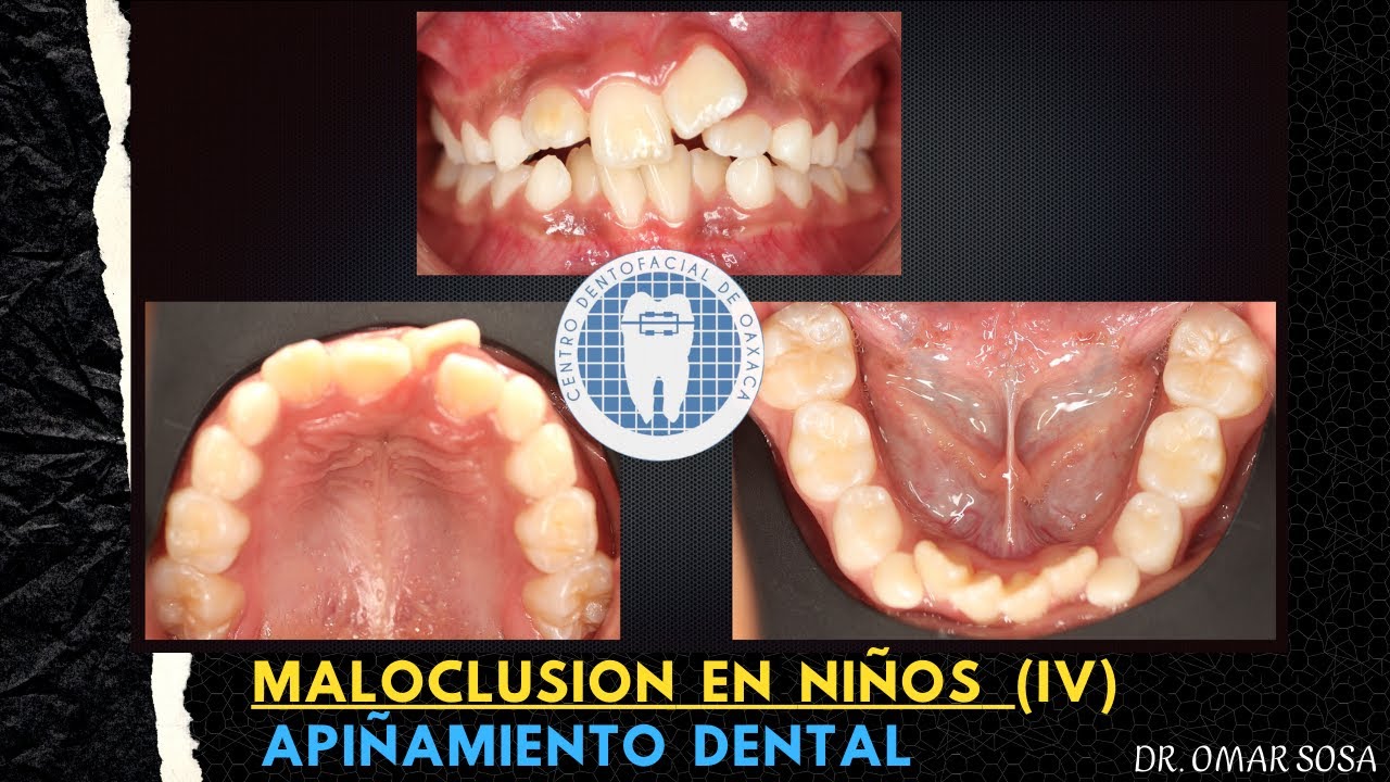 Apiñamiento Dental Maloclusión En Niños Iv Video Con Caso Clínico
