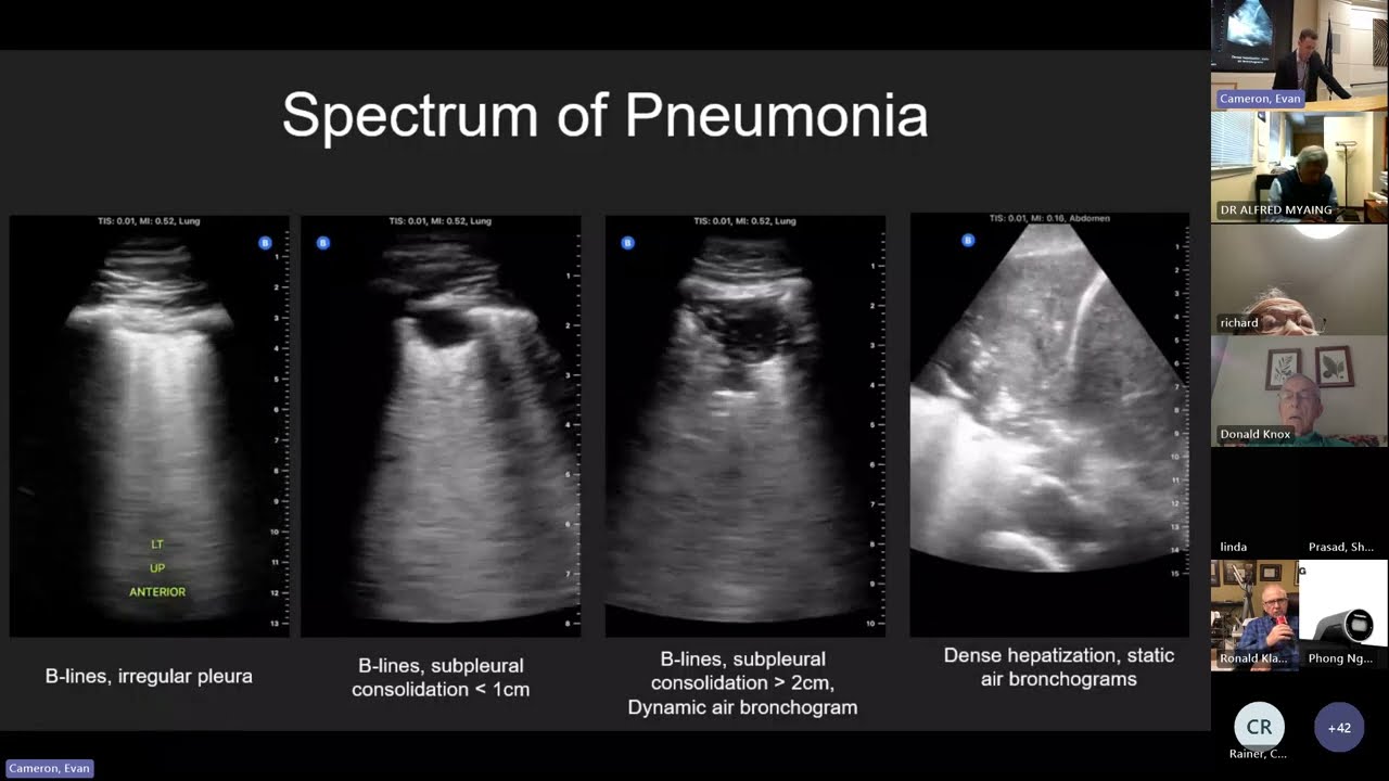 Dr Istrail S Grand Rounds On Diagnosing Pneumonia With Pocus