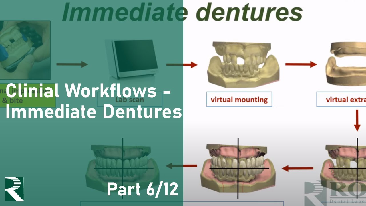 Transition Toward Digital Dentures Clinical Workflows Immediate