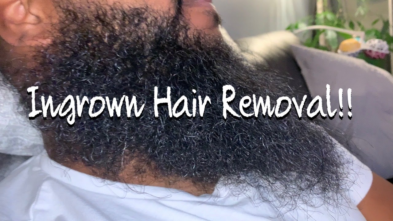 Beard Ingrown Hair Removal Pin On Beard Care Hanyatakankembali