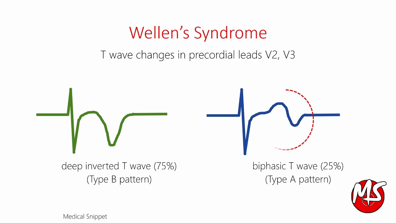 Wellens Syndrome With Ecg And Angiography Example Youtube
