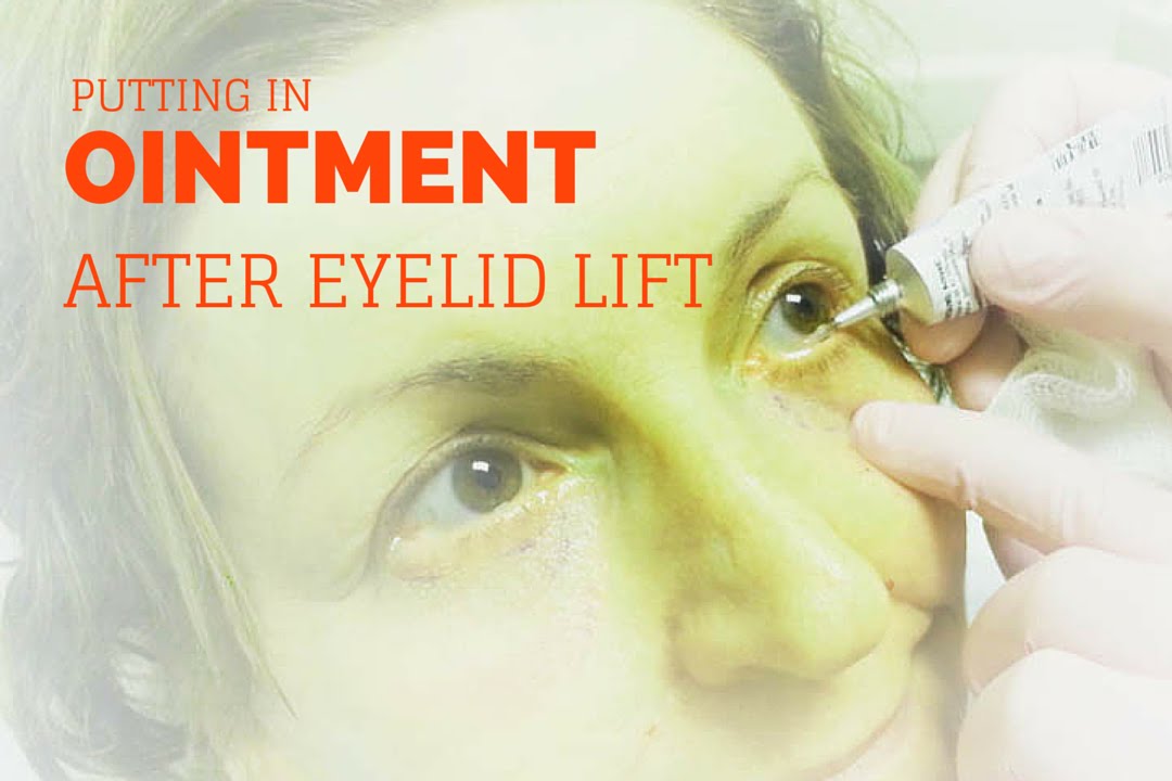 How To Apply Eye Ointment After Cataract Surgery Infoupdate Org
