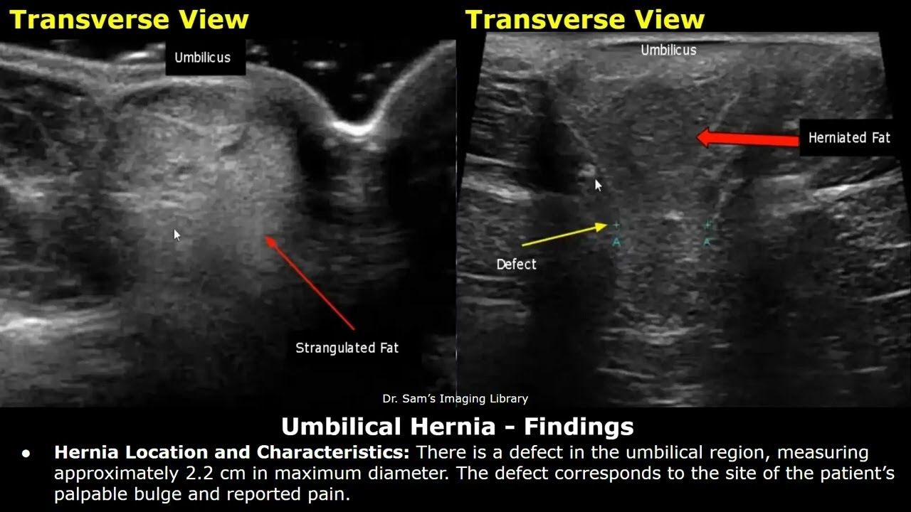 Hernia Ultrasound Reporting Direct Indirect Inguinal Epigastric