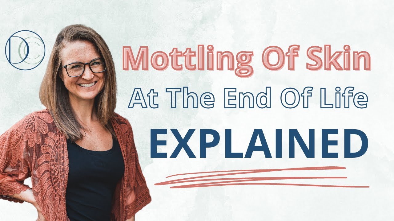 Mottling Of Skin At The End Of Life Youtube