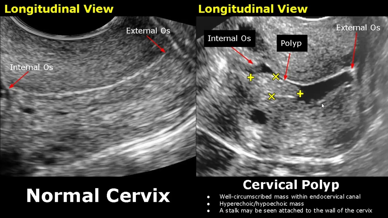 Abnormal Pelvic Ultrasound Uterus Transvaginal Ultrasound Your