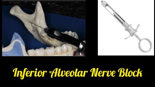 Inferior Alveolar Nerve Block Technique Overcoming Anesthesia