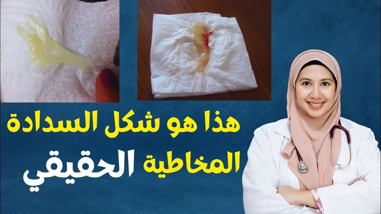 هذا هو شكل السدادة المخاطية ومتى تكون الولادة بعد نزولها Youtube