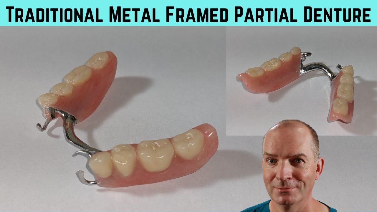 Close Up Look At A Traditional Metal Framed Partial Denture Youtube