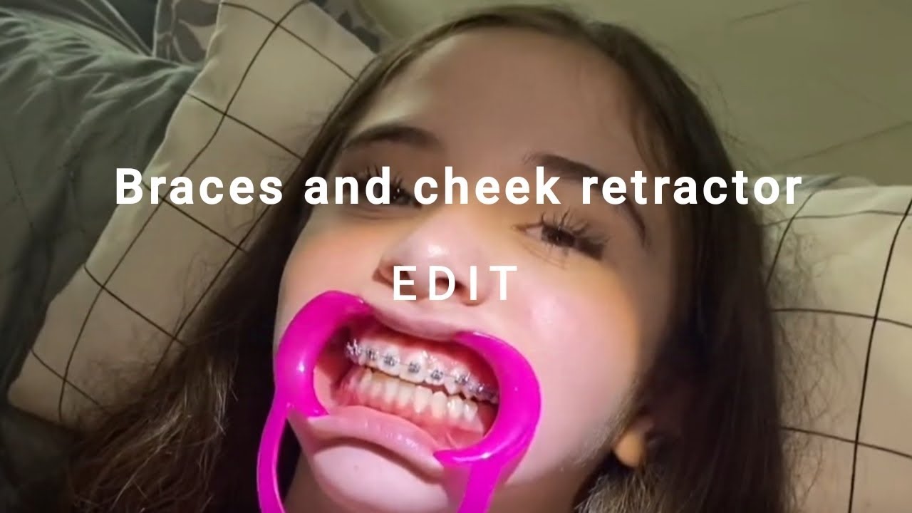 Girl Gets Braces With Cheek Retractor At Dentist Youtube