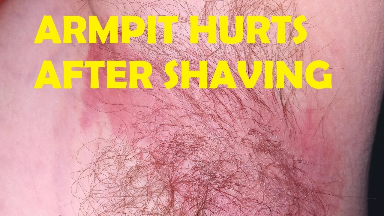 Why Do I Get Red Bumps After Shaving My Armpits At Richard Marsh Blog