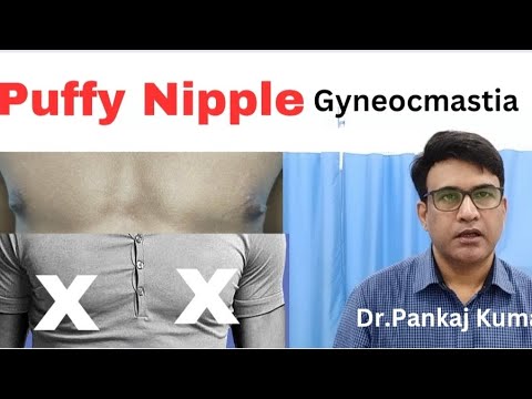 Puffy Nipples Treatment Grade 1 Gynecomastia Treatment Gynecomastia