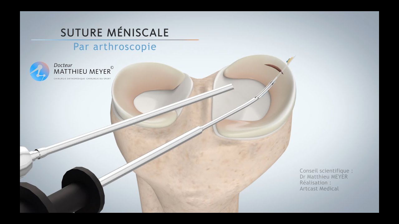 Suture Méniscale Par Arthroscopie Dr Matthieu Meyer Youtube