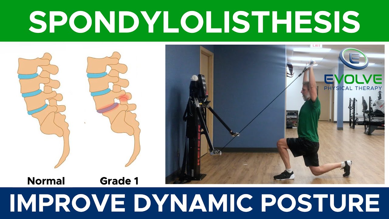 Spondylolisthesis Exercises To Improve Dynamic Lumbopelvic Stability