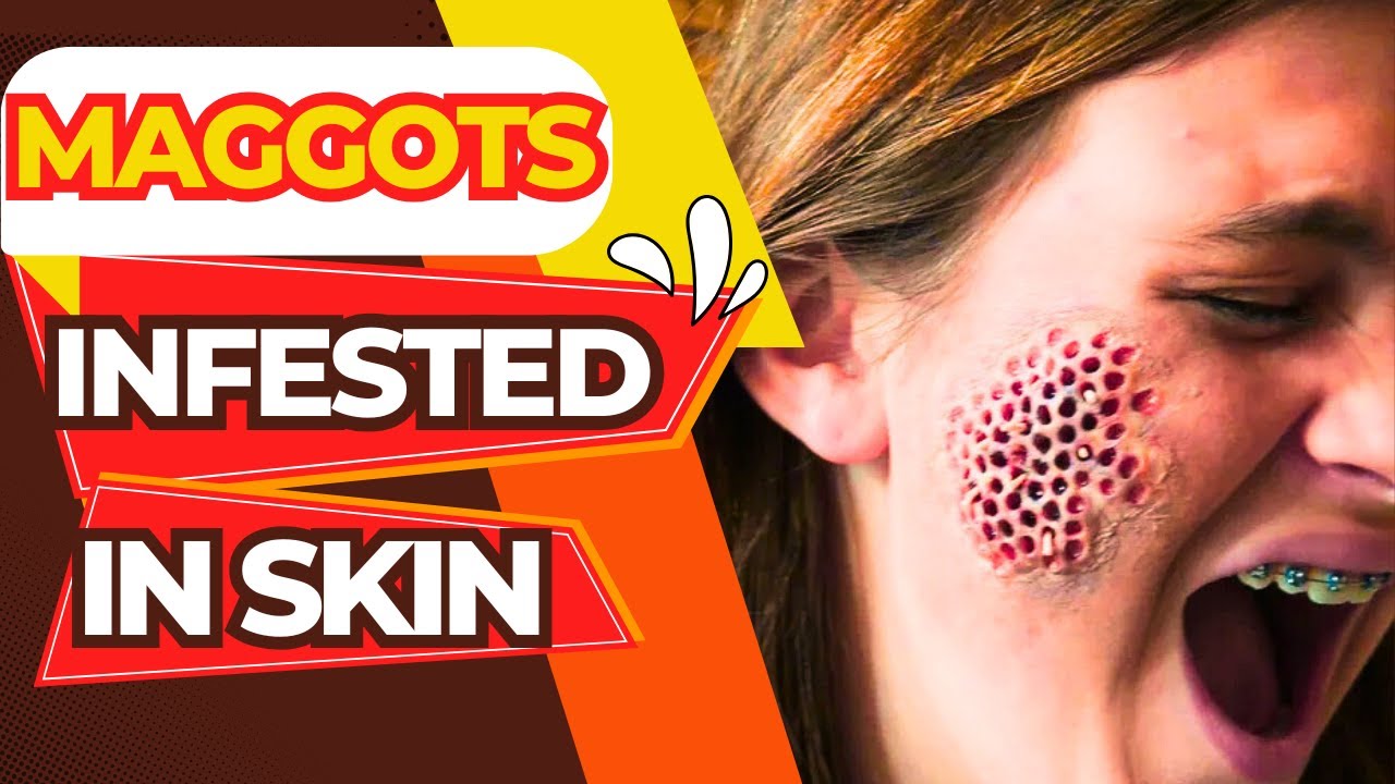 Maggots Infested Skin Cutaneous Skin Myiasis And Trypophobia Causes