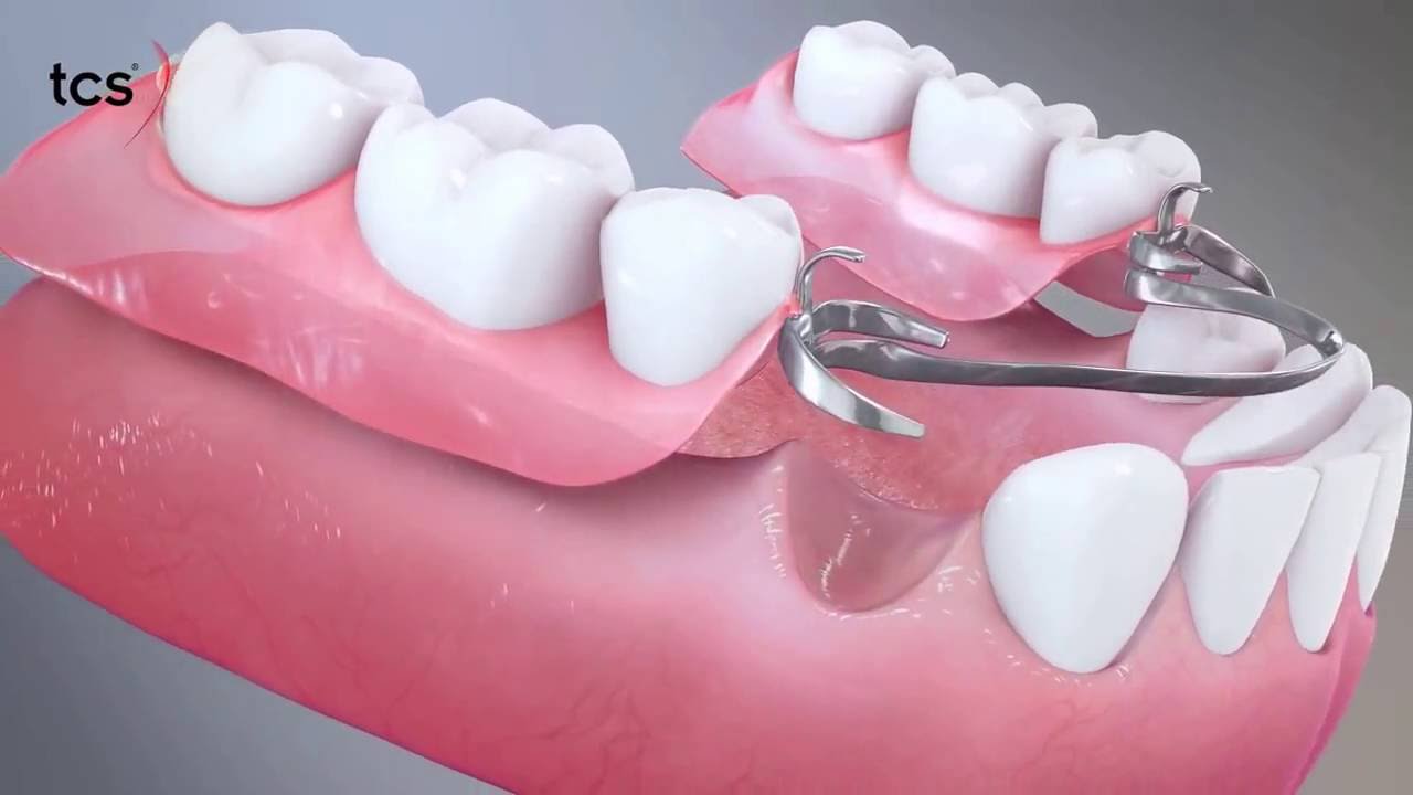 Flexible Partial Dentures Animation Video Youtube