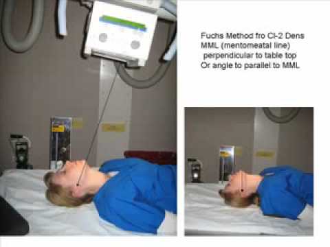 Adult Cervical Spine Fuchs Method Dens Youtube