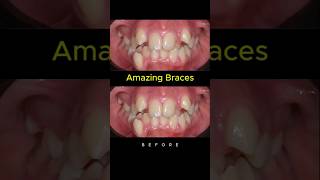 Amazing Braces Fix Crowded Teeth Process Braces Orthodontist Dentist ...