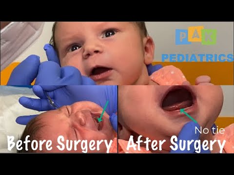 Tongue Tie Surgery On Adorable 7 Day Old Pak Pediatrics Youtube