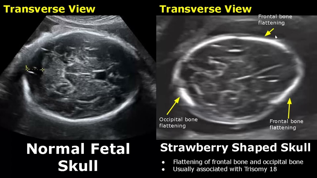 Frontal Bossing Prenatal Ultrasound
