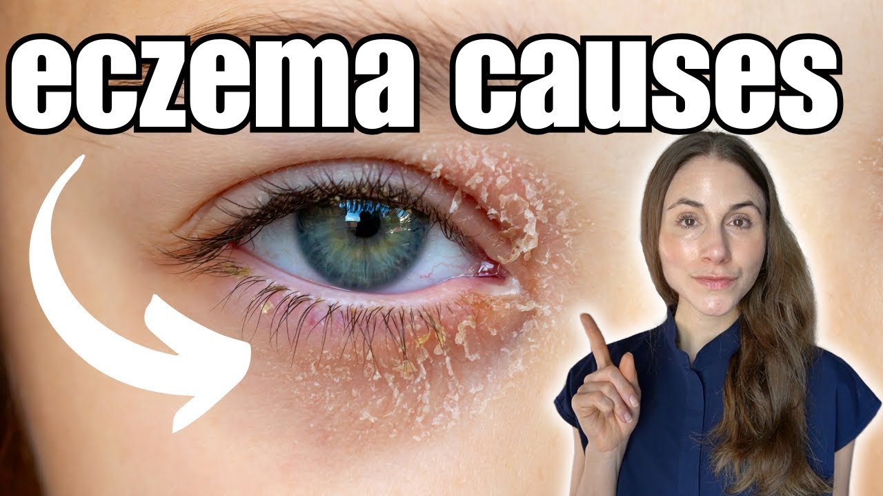 How To Treat Dry Eyelids At Home Infoupdate Org