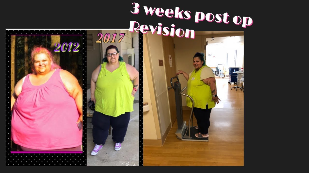 Almost 3 Week Post Op Update Youtube
