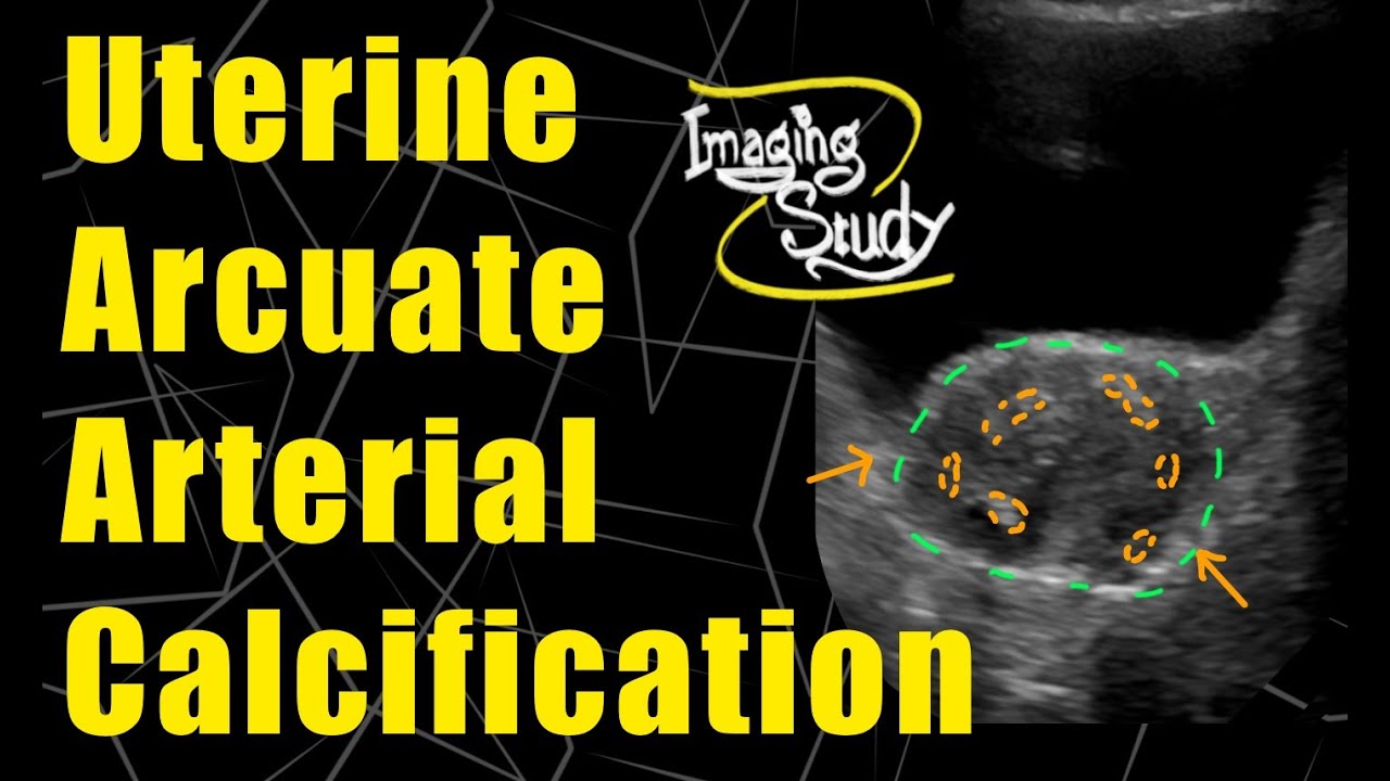 Postmenopausal Uterine Arcuate Arterial Calcifications Ultrasound