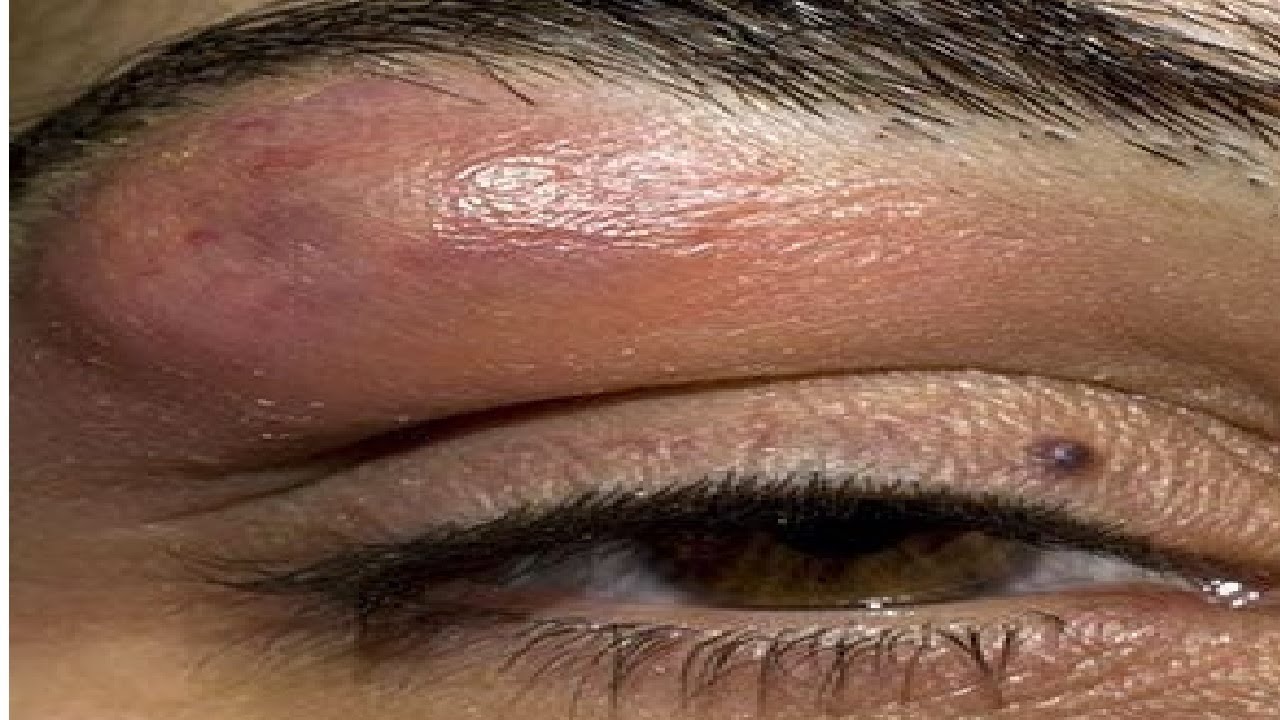 How To Get Rid Of Ingrown Eyebrow Hair Bump Youtube