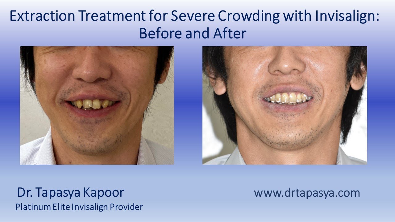 Invisalign Treatment Class Ii And Severe Crowding Correction With