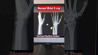 Wrist Fracture Smiths Fracture Of The Distal Radius Shorts Radiology ...