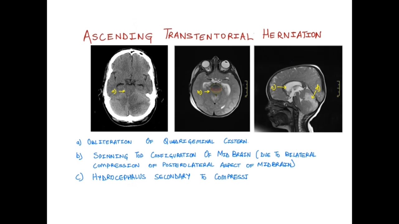 Transtentorial Herniation