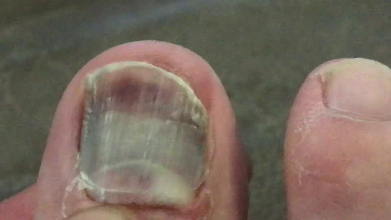 Toenail Falling Off Documentary Part 4 Youtube