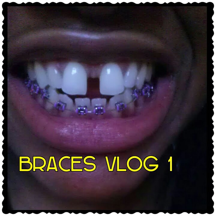 Braces Vlog 1 Update Youtube