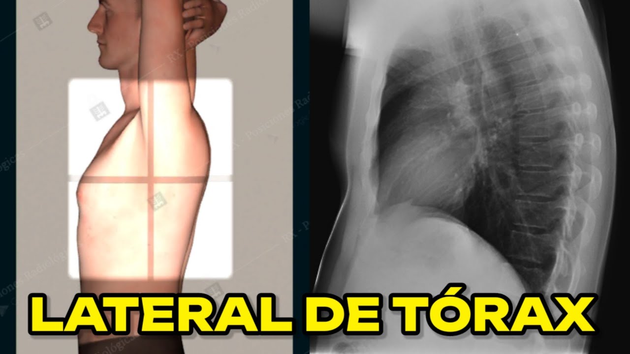 Radiografia Lateral Do Torax Proyecciones En Radiografía De Tórax